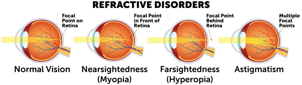 InformativeInsight.com | All you need to know about Myopia Laser Treatment